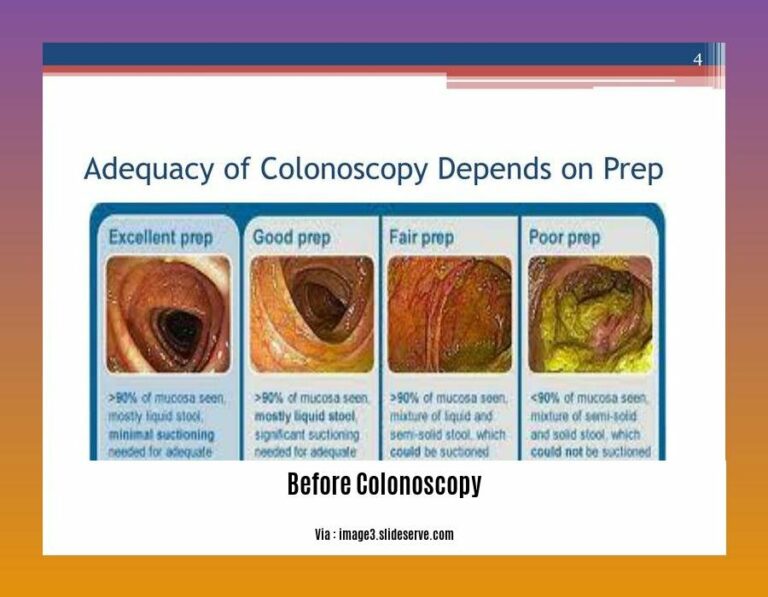 Cleaning Out Colon Before Colonoscopy: Effective Methods for a Thorough ...