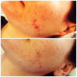 Desincrustation: Your Guide to Deeper Pore Cleansing & Extraction Prep