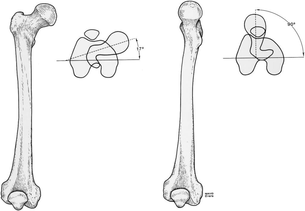 Understanding Femoral Retroversion: Symptoms, Causes, Diagnosis, and ...