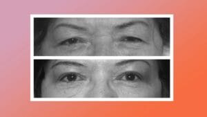Brow Ptosis: A Comprehensive Guide to Causes, Symptoms, and Treatment ...