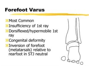Forefoot Varus: Understanding Its Impact, Diagnosis, and Treatment Options