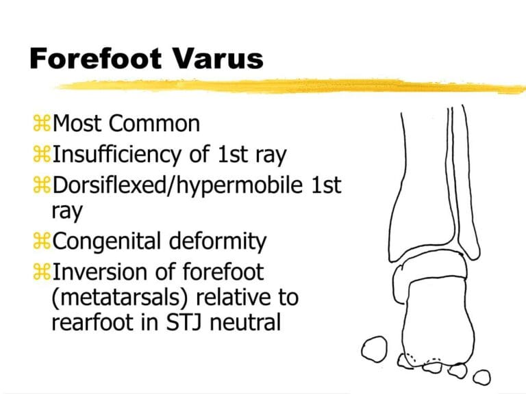 Forefoot Varus: Understanding Its Impact, Diagnosis, and Treatment Options