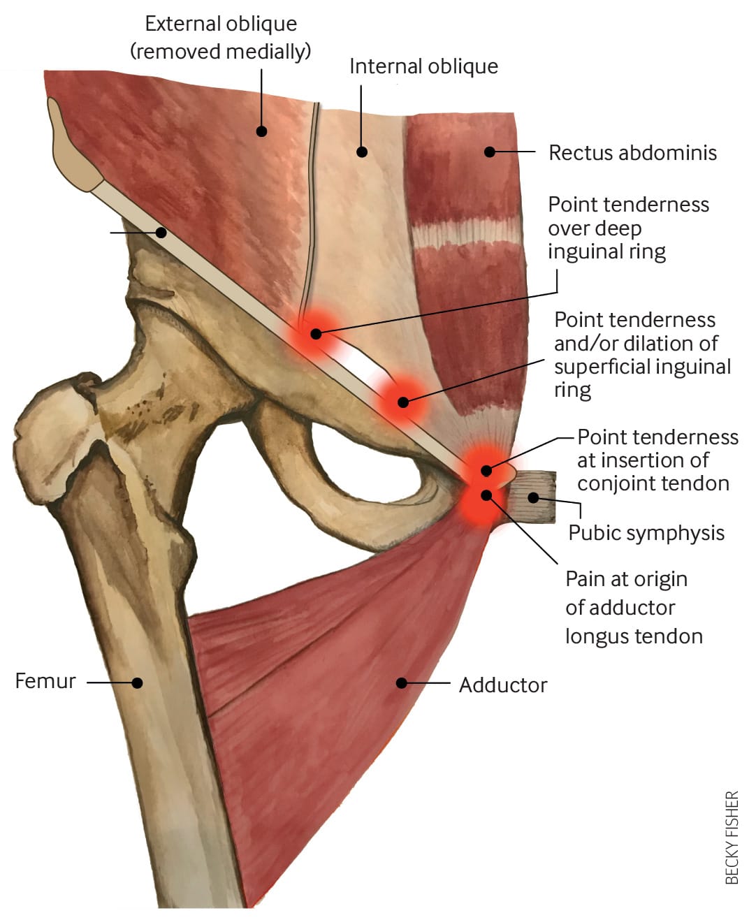 Groin Pain ICD 10 Codes 2025 A Comprehensive Guide Groin Pain ICD 10 Codes 2025 A Comprehensive Guide