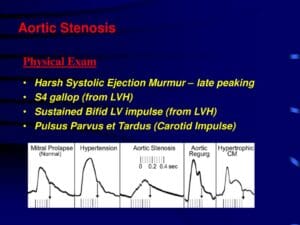 Understanding Pulsus Parvus et Tardus: Its Link to Aortic Stenosis and ...