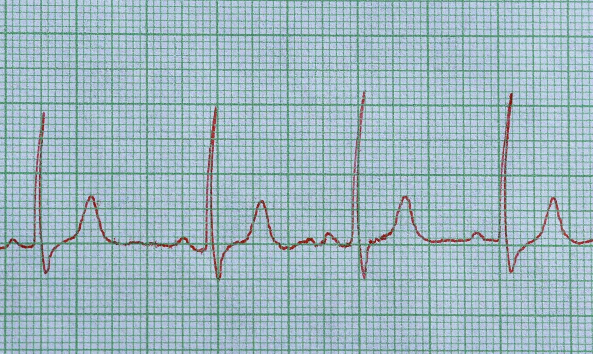 Understanding Sinus Rhythm with Premature Junctional Contractions (PJCs)