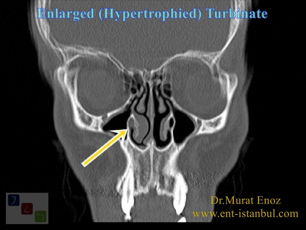 Swollen Turbinates: A Visual Guide with Pictures, Causes, and Treatments