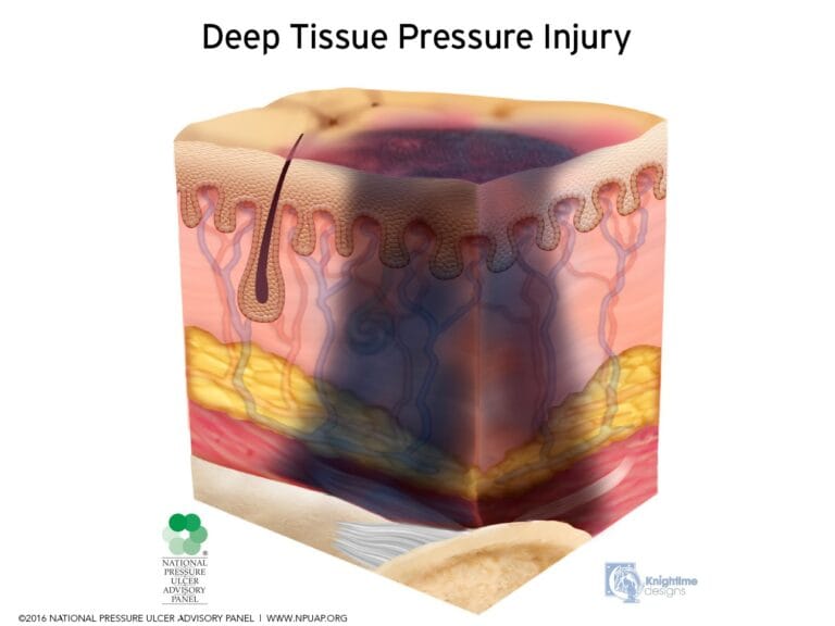 Unstageable Pressure Injuries: A Comprehensive Guide to Understanding ...