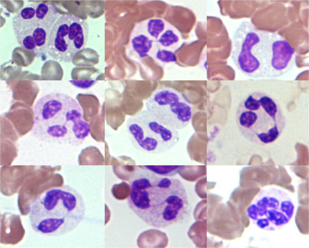 Vacuolated Neutrophils: What Their Presence Reveals About Infection and ...