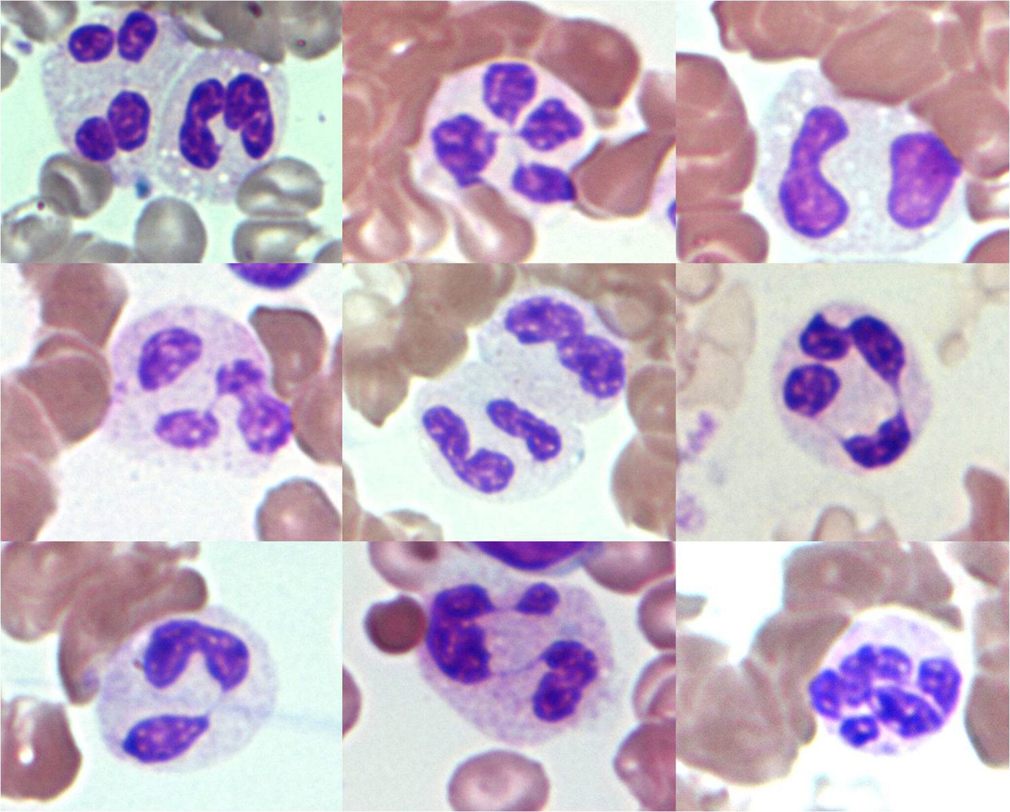 Vacuolated Neutrophils: What Their Presence Reveals About Infection and ...