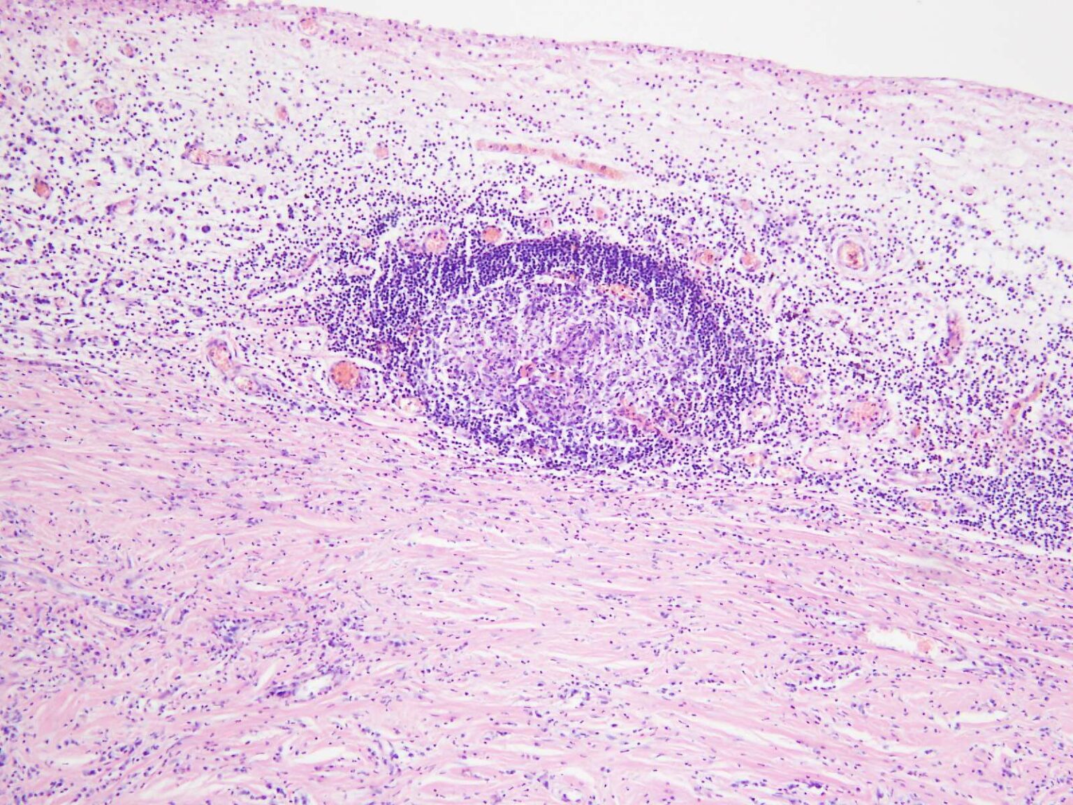 Understanding Calcified Fibroids: Symptoms, Diagnosis, and Treatment ...