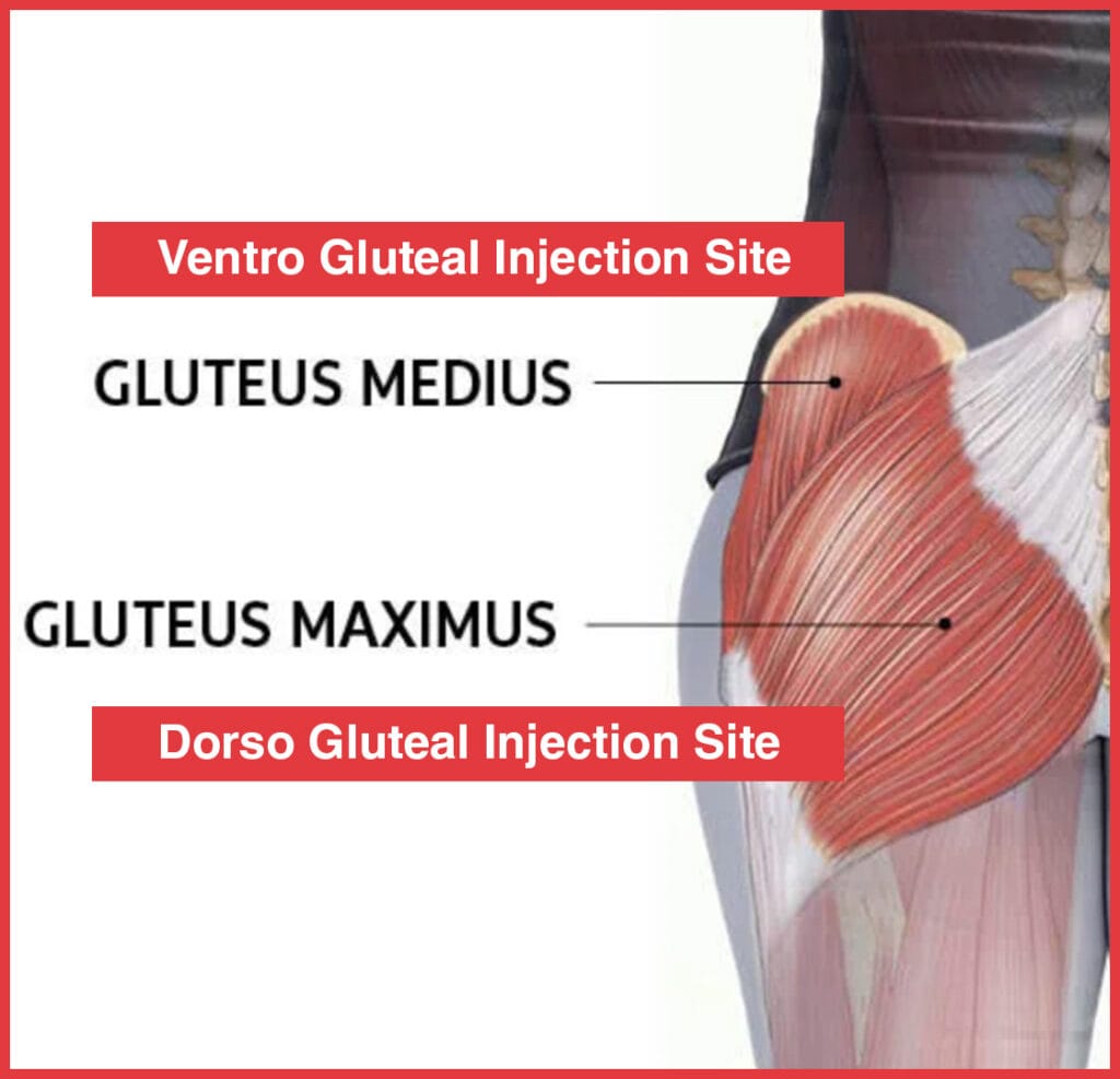 Dorsogluteal Injections: Why This IM Site Is Generally Avoided