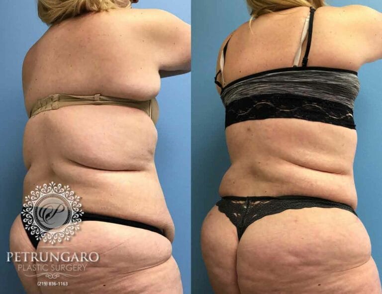 Fleur de Lis Tummy Tuck: Your Ultimate Guide to Abdominal Reshaping After Weight Loss