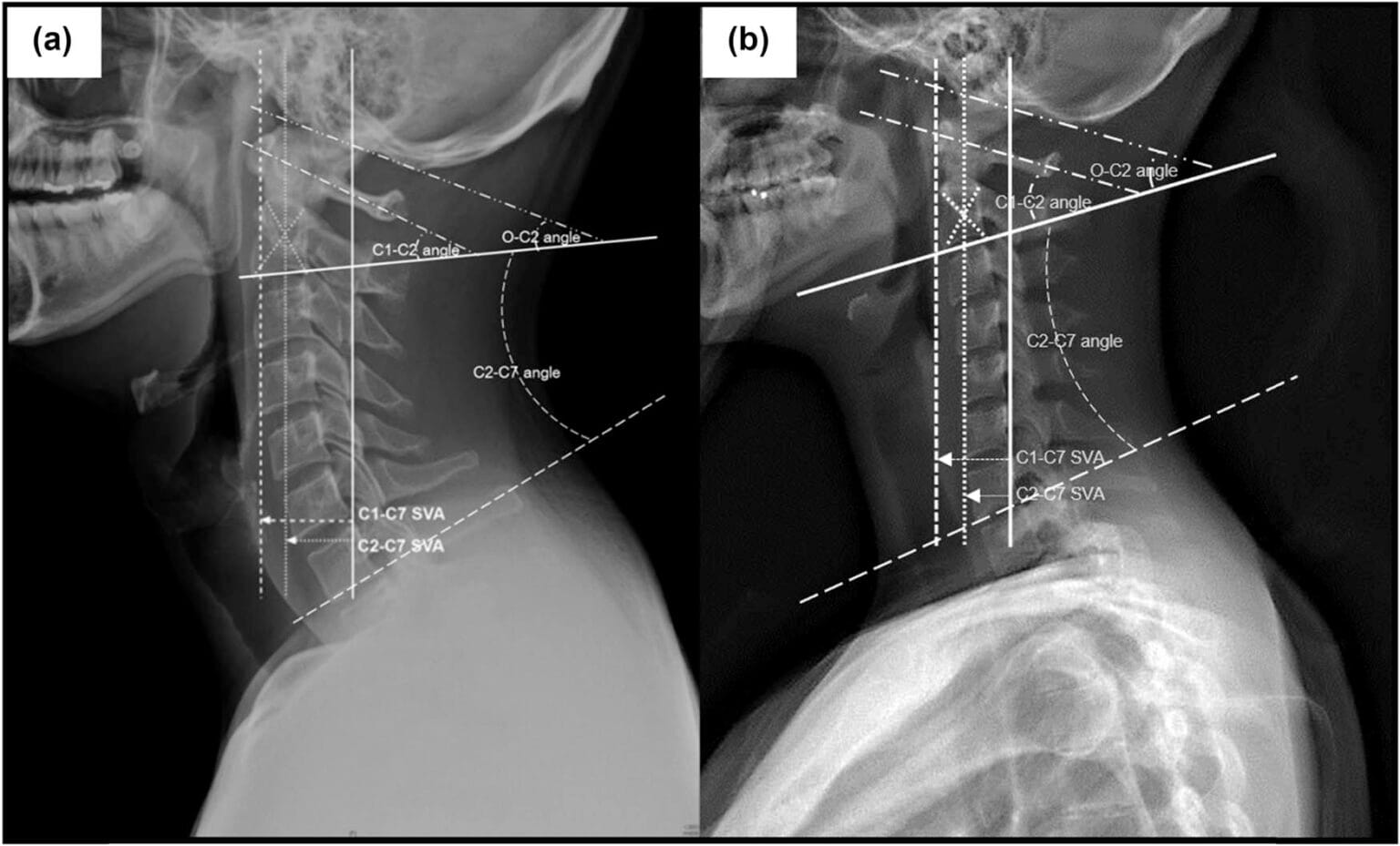 Reversed Cervical Lordosis: Causes, Symptoms, and Treatment Options