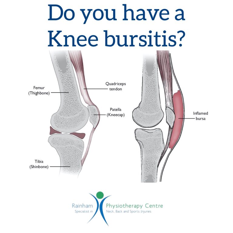 Suprapatellar Bursitis: Understanding Its Causes, Symptoms, Treatment ...