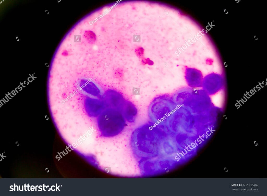 Tzanck Test: A Definitive Guide to Diagnosis and Applications